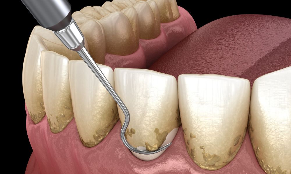 Periodontal Maintenance for Long-Lasting Gum Health in Broomfield